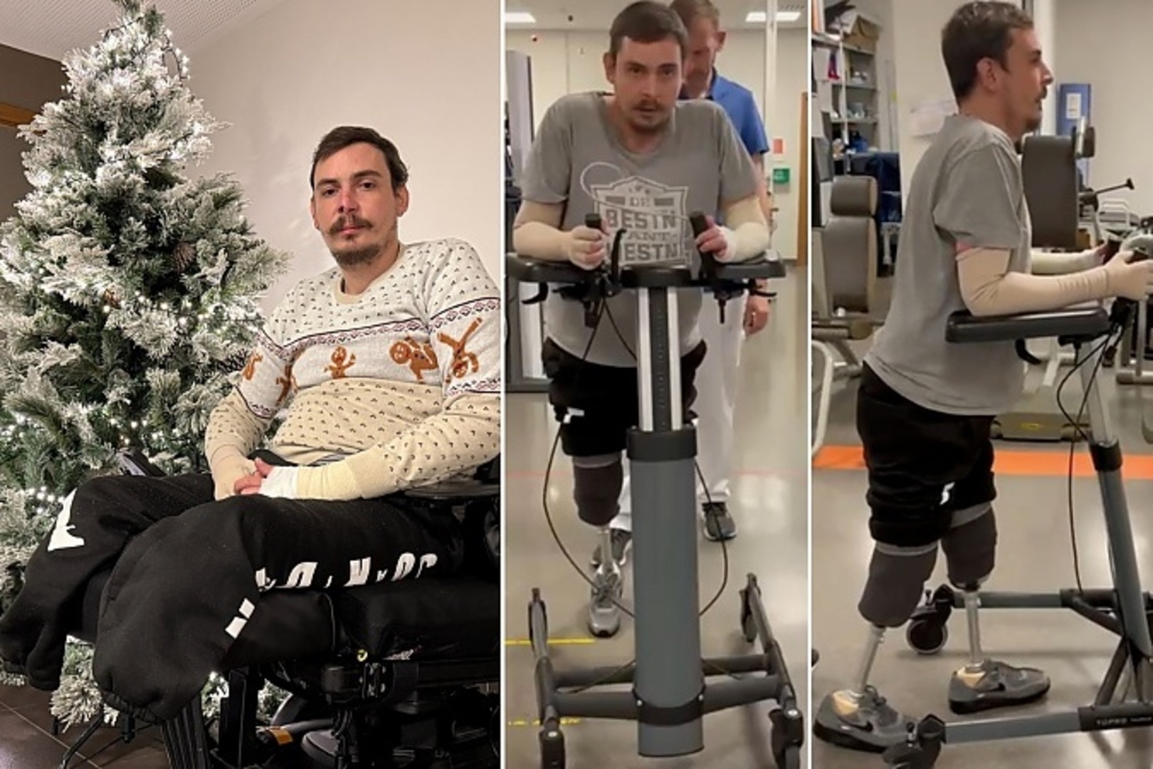 Ian (34) zet eerste stappen nadat hij onderbenen, twee vingers en stuk ...